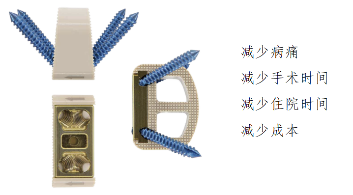 Chunli Medical's "Self - Stabilizing Interbody Fusion Cage" Has ...