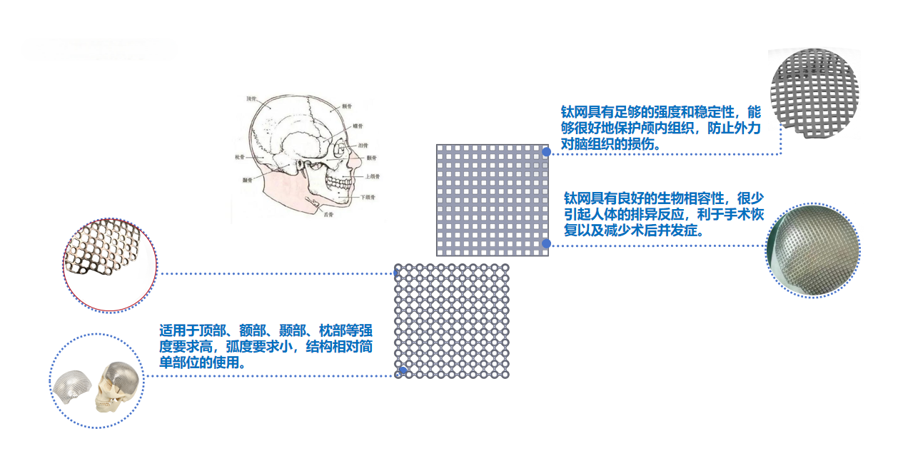 Great News! Chunli Medical’s Titanium Mesh Plate System Has Obtained ...